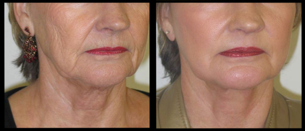 A Reason to Be Thankful: Turkey Neck Treatments that Work - California ...