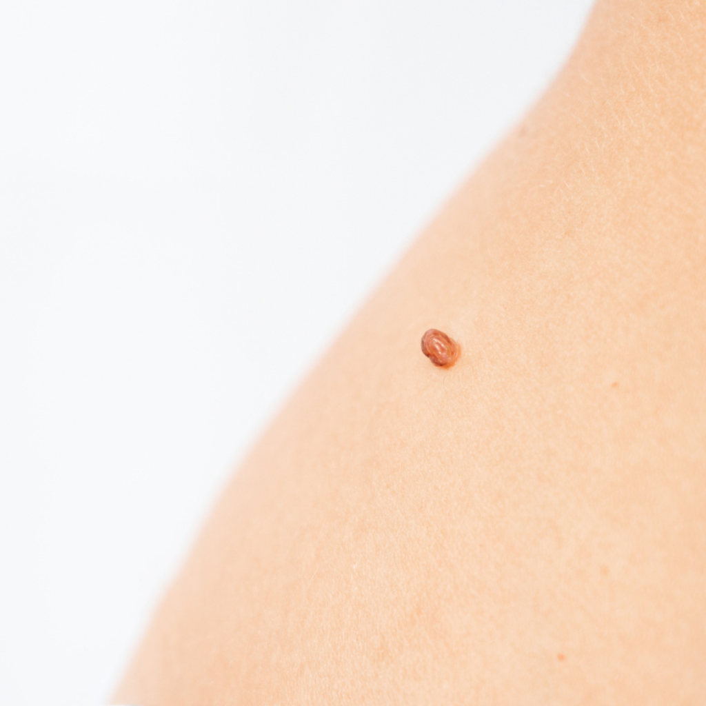 Skin Tags – What are they and what to do about them? - California Skin ...